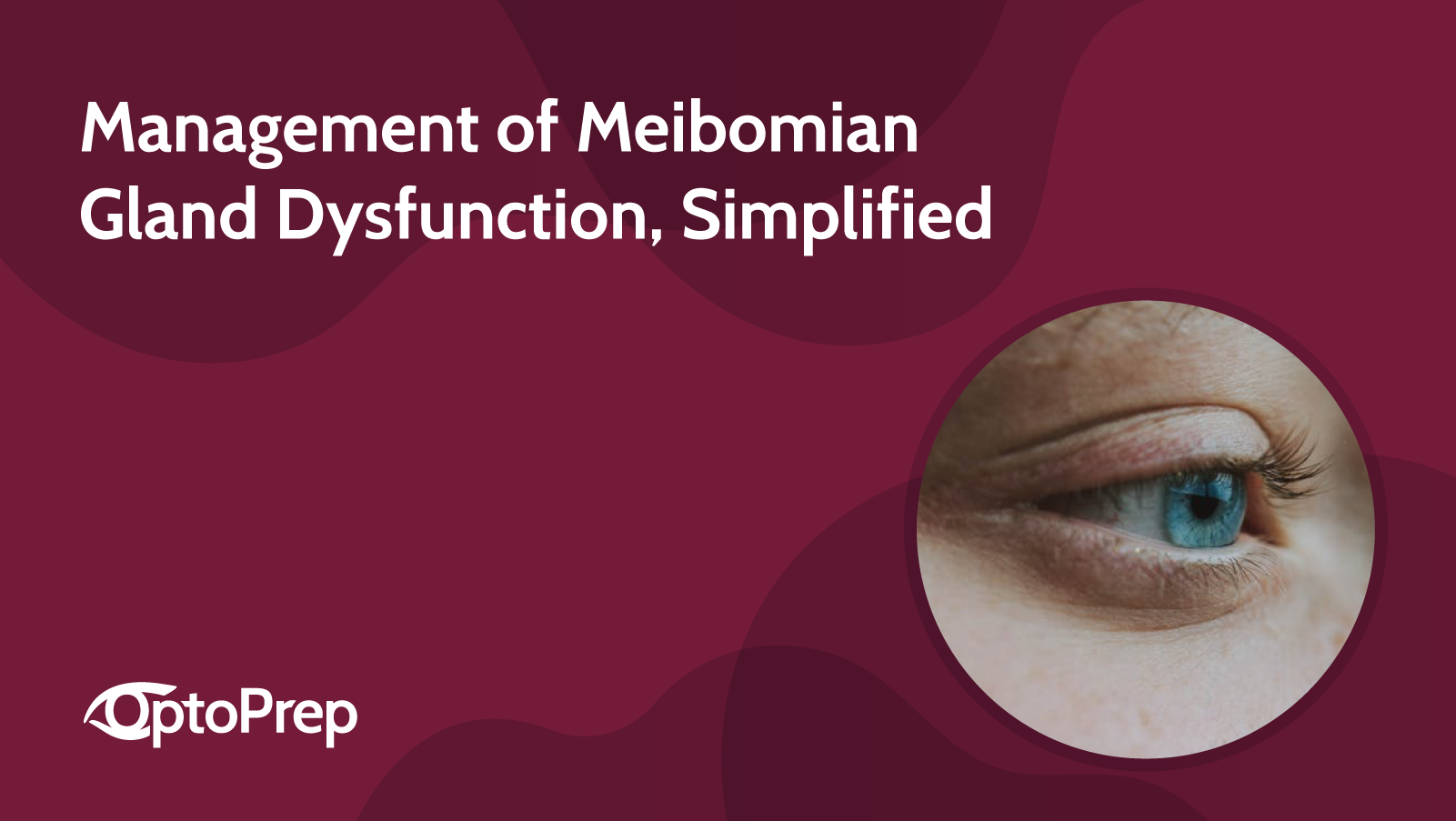 Management of Meibomian Gland Dysfunction, Simplified